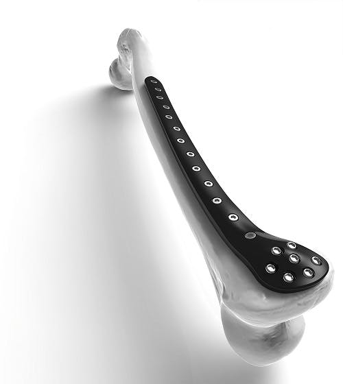 A new metal-free solution for patients that may improve treatment - Victrex